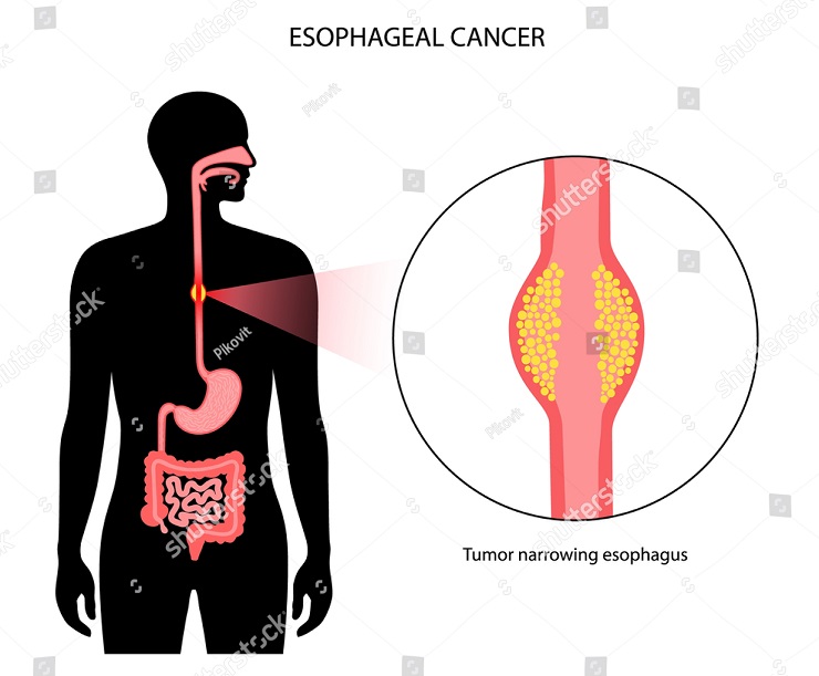 Digestive System Cancers - SRM Global Hospitals Pvt Ltd