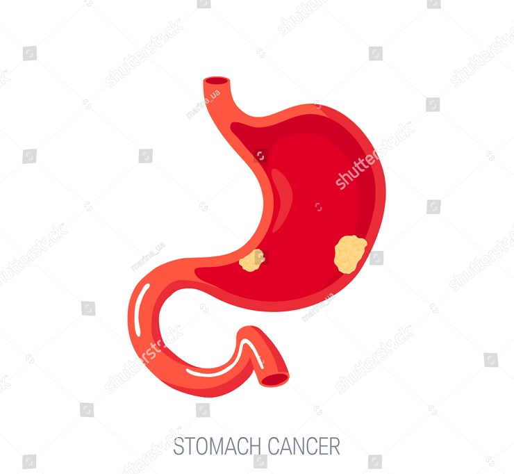Digestive System Cancers - SRM Global Hospitals Pvt Ltd