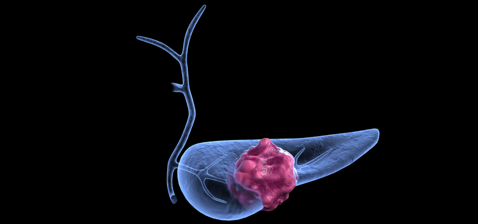 Managing Pancreatic Stones: Symptoms, Causes, and Effective Treatments ...